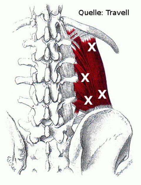 Carré des lombes : douleurs et trigger points