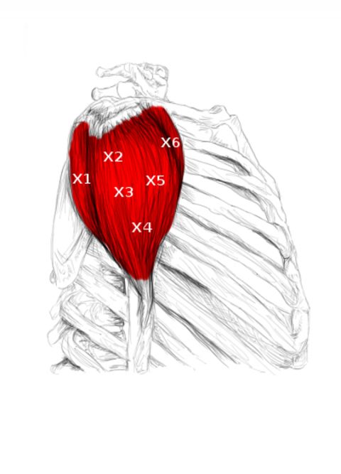 Muscle deltoïde : douleurs et trigger points