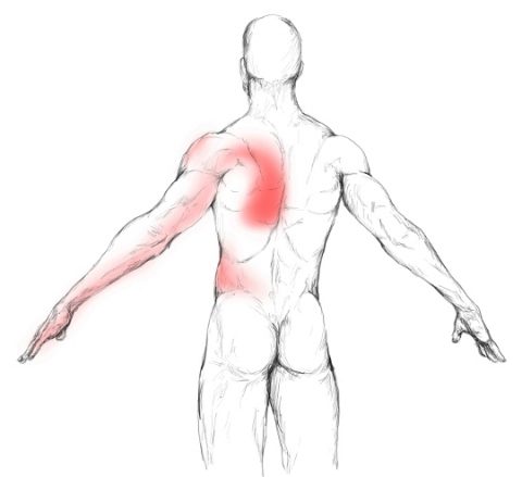 Muscle grand dorsal : douleurs et trigger points