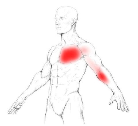 Grand pectoral : douleurs et trigger points