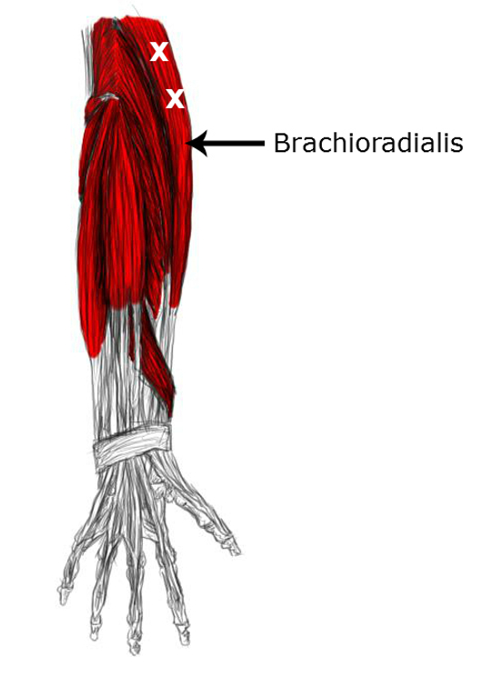 Muscle long supinateur : douleurs et trigger points