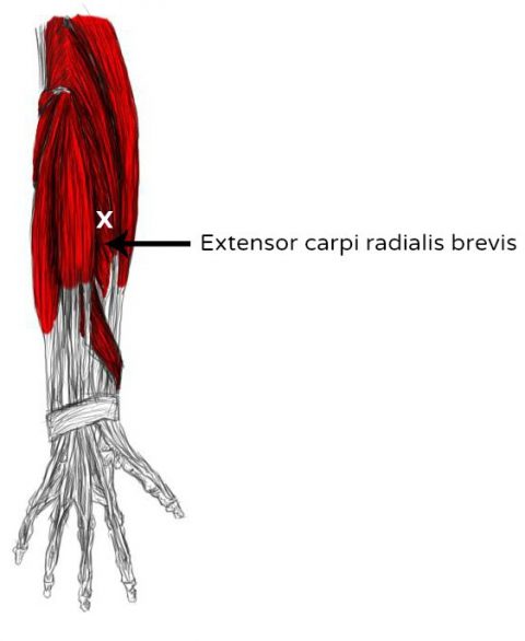 Muscle court extenseur radial du carpe : douleurs et trigger points