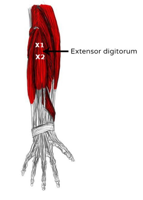 Muscle extenseur des doigts : douleurs et trigger points