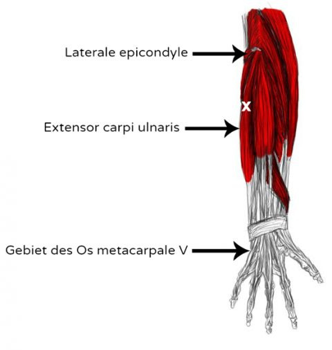 Muscle extenseur ulnaire du carpe : douleurs et trigger points