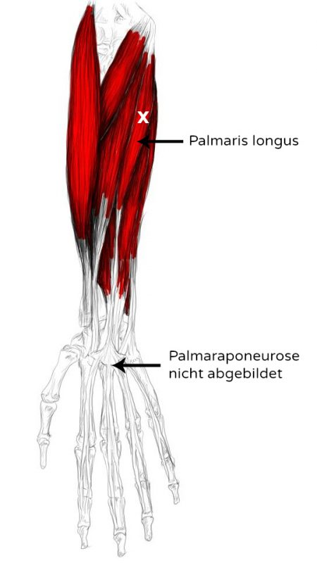 Muscle long palmaire : douleurs et trigger points