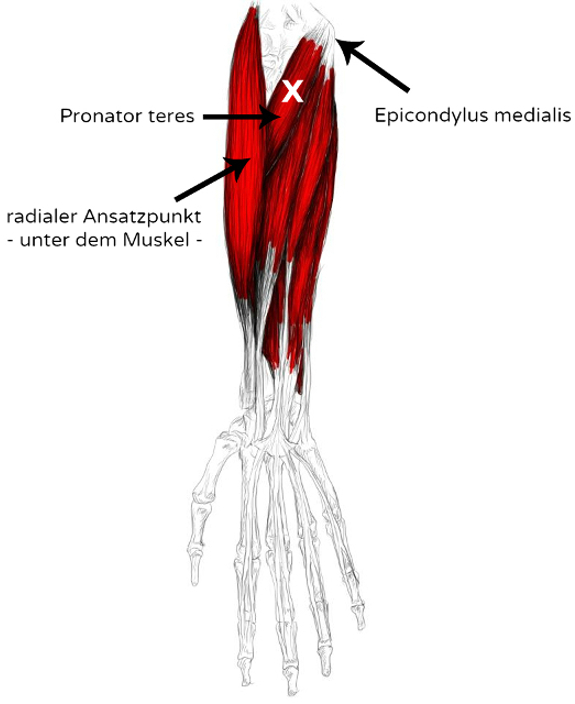 Muscle rond pronateur : douleurs et trigger points