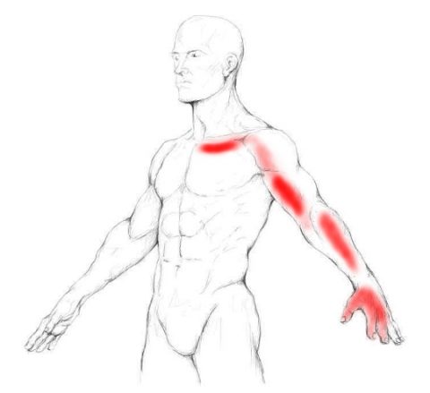 Muscle subclavier : douleurs et trigger points