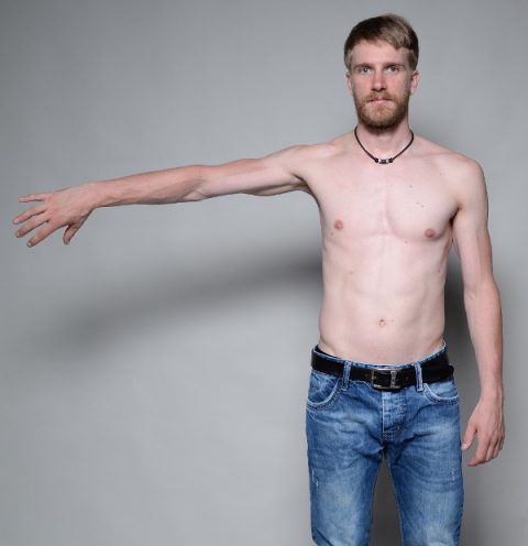 Muscle subclavier : douleurs et trigger points