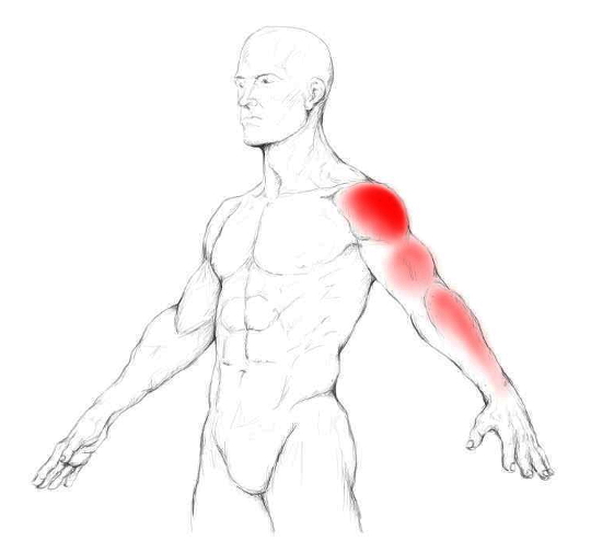 Muscle supra-épineux : douleurs et trigger points
